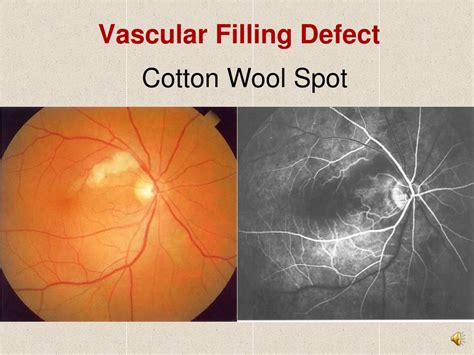 Ppt Fluorescein Angiography And Oct In Diabetic Retinopathy Powerpoint
