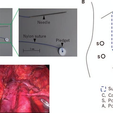 A Pictures Showing The Laptraction B Trocar Placement For