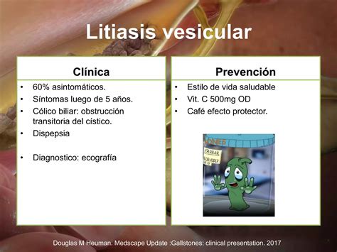 Litiasis Vesicular Pptx