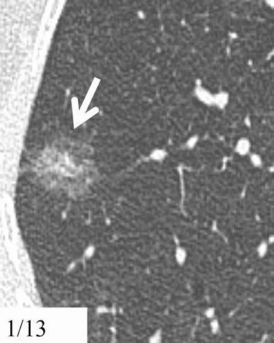 Guidelines For Management Of Incidental Pulmonary Nodules Detected On