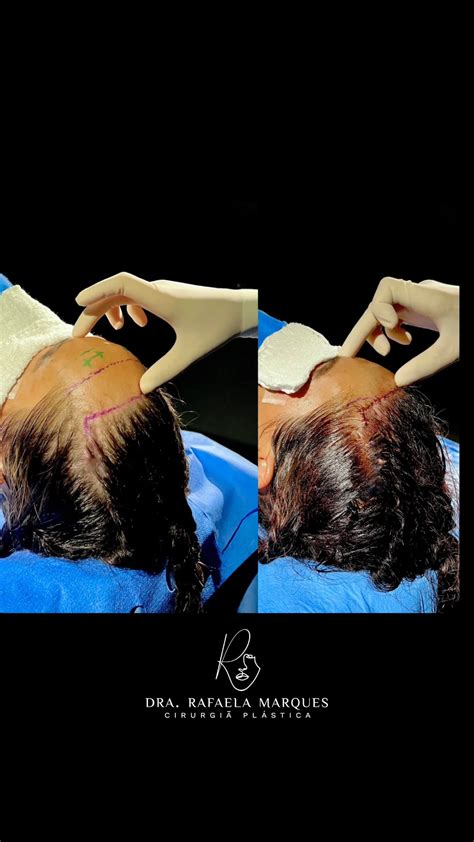 Frontoplastia Como Funciona A Cirurgia De Redução Da Testa Dra
