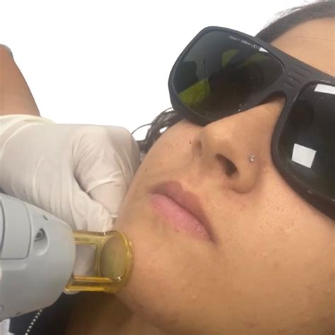 Laser Hair Removal Chin In Orlando Vellisimo Laser And Spa