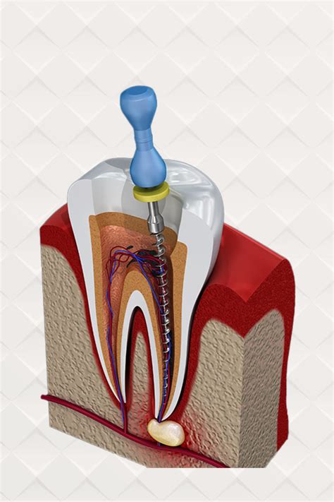 Root Canal Laser Tech Nogales Strategic Implantology Care