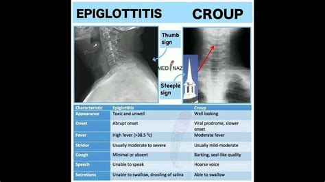 Normal Epiglottis Lateral Neck