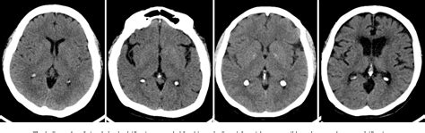 Pineal Gland Calcification