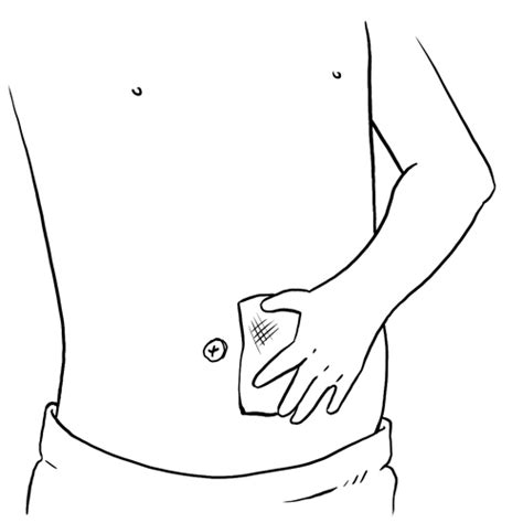 Intermittent Catheter Mitrofanoff Nettoyer Complex Care At Home For