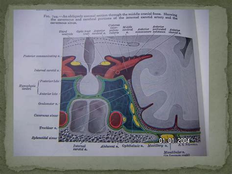 Complex Odontogenic Infection Pptx