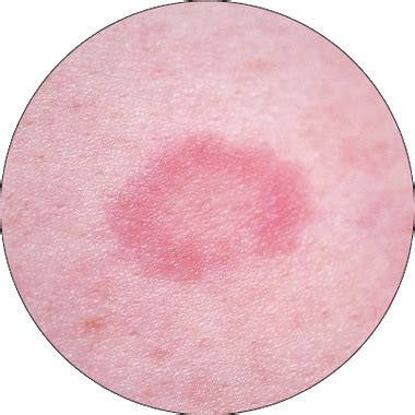 Treatment Resistant Annular Rash