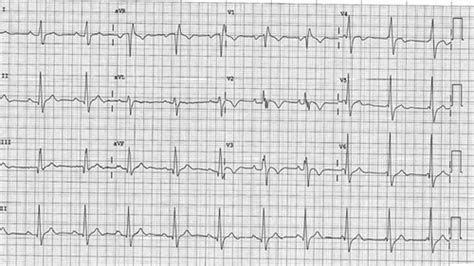Atrial Septal Defect Ecg