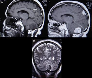 Brain Meningioma Imaging Practice Essentials Radiography Computed