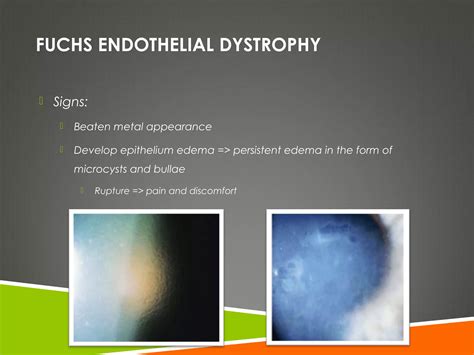 Fuchs Dystrophy And Pseudophakic Bullous Keratopathy Ppt