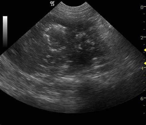 Pancreatic Abscess And Suppurative Pyogranulomatous Inflammation In A 4