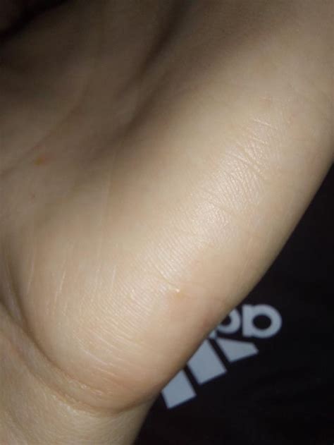 Is This Post Scabies Help R Scabies