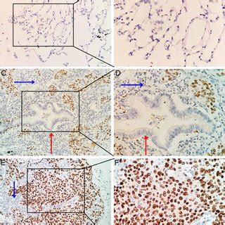 IHC Staining Of RUNX2 In LUSC And Noncancer Lung Tissues A IHC