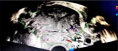Doppler Examination Revealed A 14 × 20 × 07 Cm Hypoechoic Area Was