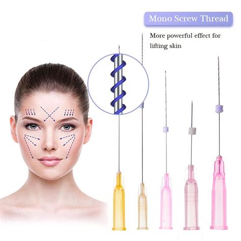 Minerva Pdo Threads For Face Lift Pdo Monoscrew Threads Smooth Type