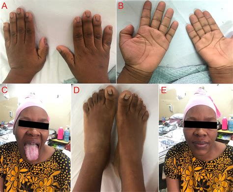 Image A And Image B Show Huge Spade Like Hands Image C Shows