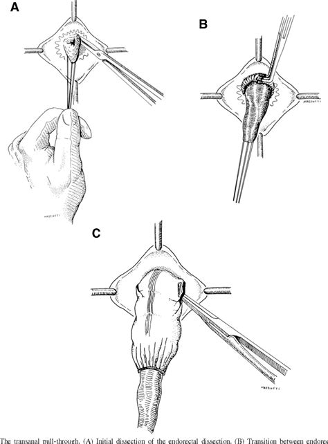 Figure 2 From Laparoscopic And Transanal Pull Through For Hirschsprung Disease Semantic Scholar