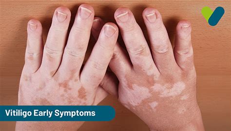 Vitiligo Early Symptoms Detailed Guide On The Early Signs Of Vitiligo