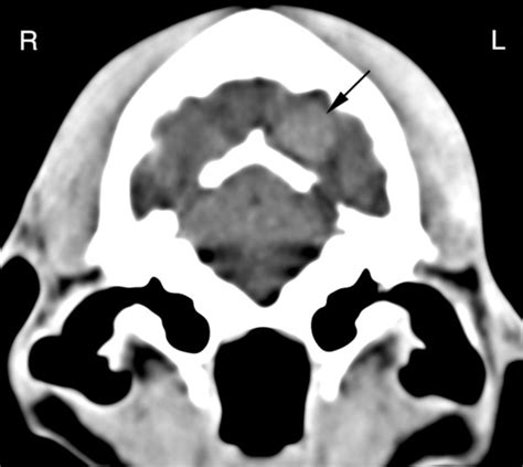 Transverse Precontrast Ct Brain Image With 3 Mm Slice Thickness Download Scientific Diagram