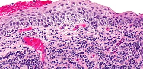 Enfermedades Del Pene Que Es La Balanitis