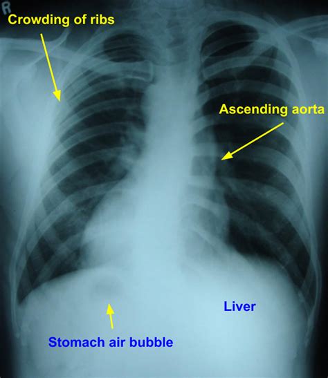 Dextrocardia
