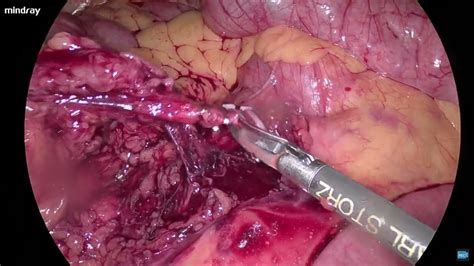 Laparoscopic Right Hemicolectomy Youtube