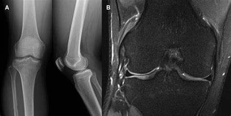 A Plain Knee Radiograph Before Surgery B Mri Coronal Image There