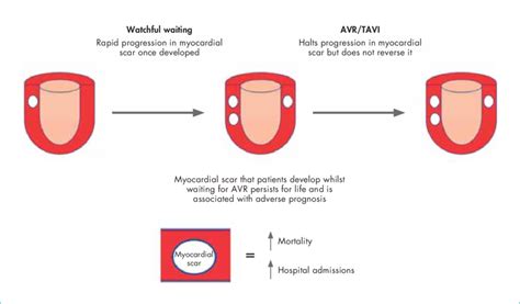 Myocardial Scar In Aortic Stenosis Cardiovascular Magnetic Resonance
