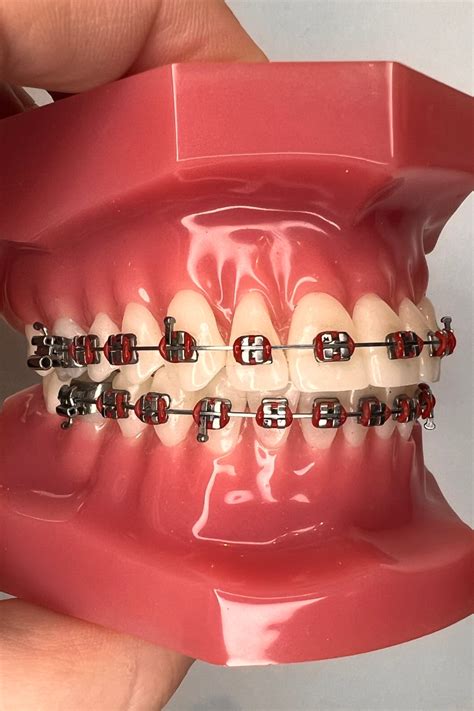 Red Braces Bands Discover 20 More Red Braces Color Combos Braces Colors Pink Braces Braces