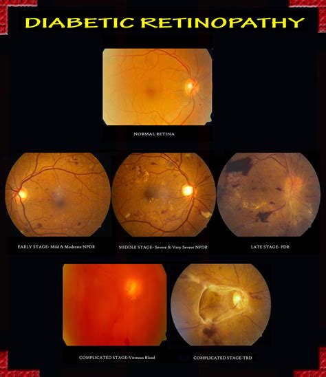 Diabetic Retinopathy