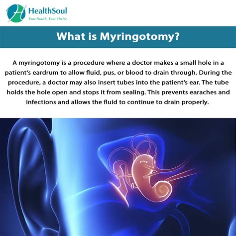 What Is Myringotomy Incision Myringotomy Ear Tubes Zonxt
