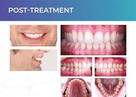 Crowding On Upper And Lower Teeth Midline Discrepancy Trioclear®