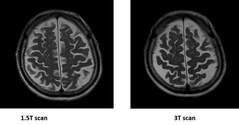 Mri Signal To Noise Ratio Related Artifact Snr Artifacts