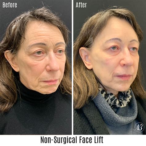 Surgical Face Lift Non Surgical Facelift Treatment