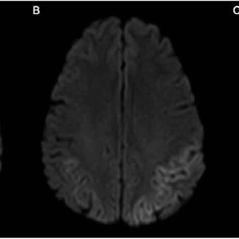Mri Brain Fig 2a Axial T2 T2 Hyperintensity Persists In Splenium Of