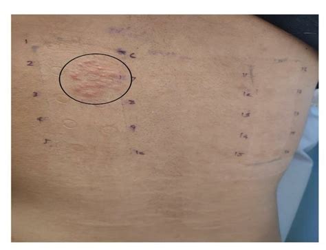 Patch Test Units Applied Over Back Download Scientific Diagram