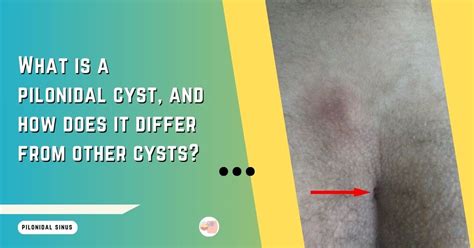 Difference Between A Pilonidal Sinus And A Pilonidal Cyst