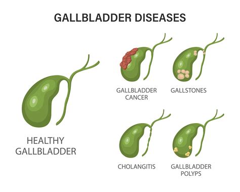 Gallbladder Disease Risks And Symptoms Dr Manju