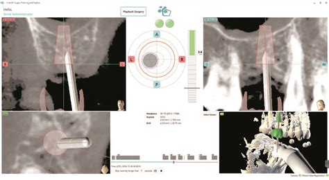 Dynamic Navigation Implant Placement In Close Proximity To Sinus Floor