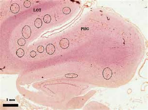 Distribution Of β Amyloid Aβ Deposits Along The Lateral Download Scientific Diagram