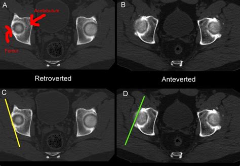 Is Acetabulum Retroversion Caused By Pelvis Dysfunction Cor