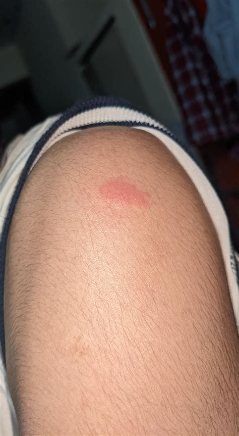 After Tt Injection In Shoulder Its Get Swelling And Redness What To Do R Askdoctorsmeeee