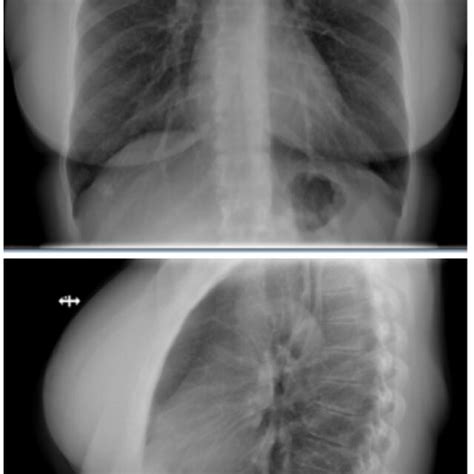 Initial Chest X Ray Cxr Pa And Lateral Showing Linear Opacity Best Download Scientific