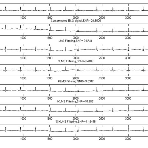 A Ecg Signal B Contaminated Ecg Signal With Baseline Wander Download Scientific Diagram