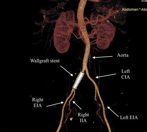Post Stent Graft Deployment Pelvic Dsa Showing The Stent In Position Download Scientific