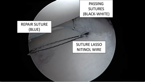 Arthroscopic Shoulder Labral Repair Using Knotless All Suture Anchor