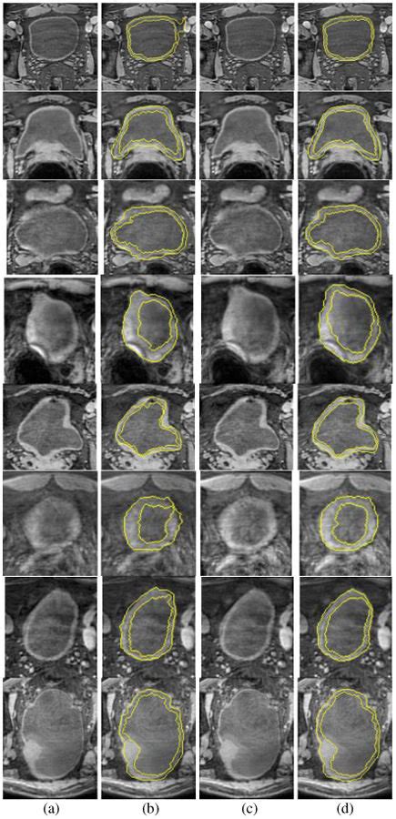3d Bladder Wall Segmentation Results Illustrated Via 2d Axial Views Download Scientific Diagram