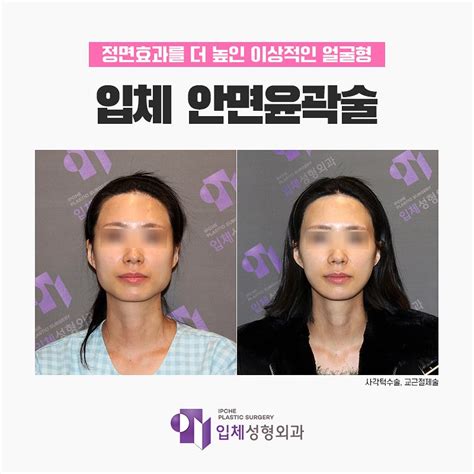 입체성형외과의원 사각턱 뼈만 깎으면 갸름해질까 No 뼈는 필요한 만큼만 절제 연부조직을 함께