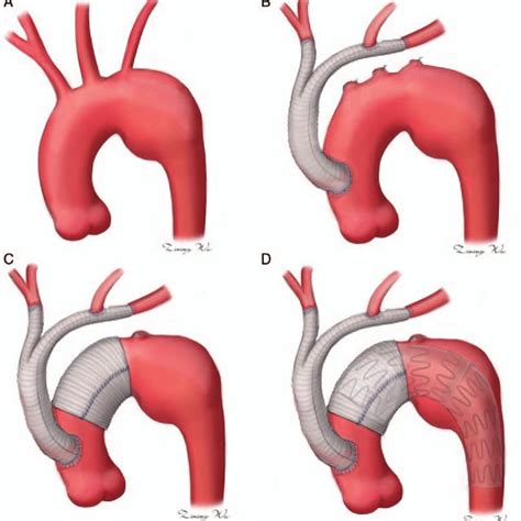 Pdf Debranching Thoracic Endovascular Aortic Repair Combined With Ascending Aortic Aortoplasty